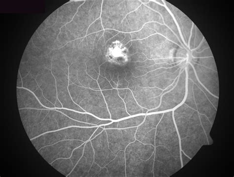 Idiopathic Choroidal Neovascularization Retina Image Bank