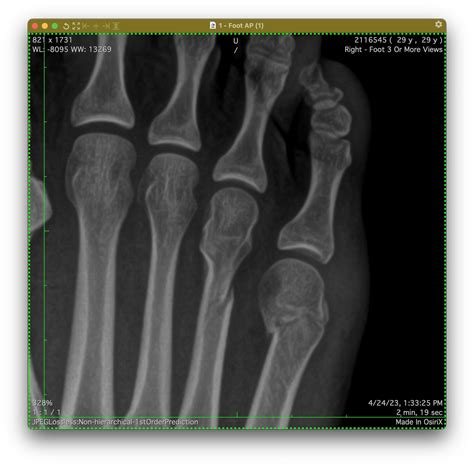 5th Metatarsal Head Fracture R Brokenbones