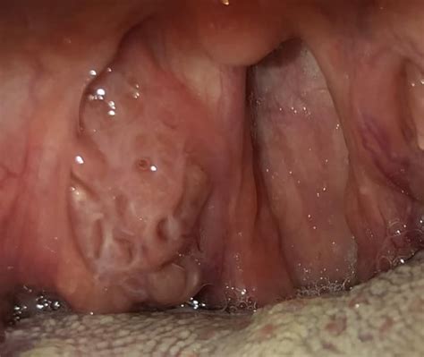 Lump Below Tonsil And Light White Film Coating Cyst Raskdoctorsmeeee