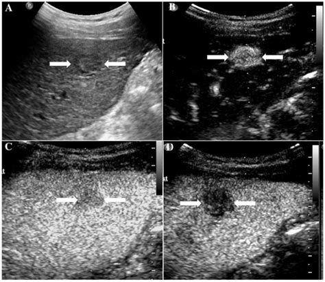 It Illustrates An Example Of Misinterpretation With Li Rads Ceus Download Scientific Diagram