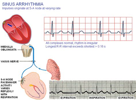 Characteristics Of Sinus Node Arrhythmias