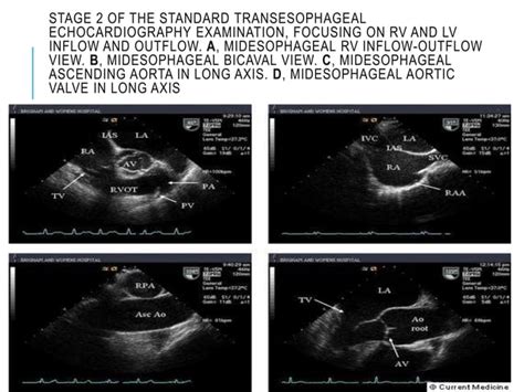 Transesophageal Echocardiography Pptx