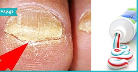 ფრჩხილის სოკო სამუდამოდ დავამარცხე ამაში კი აი ეს საშუალებები დამეხმარა Vap Ge