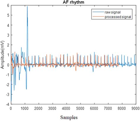 Raw Af Ecg Signal Versus The Processed Signal Noisy Parts Of Signal