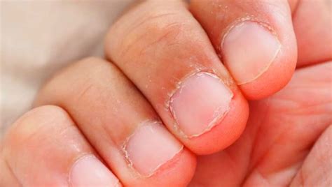 Qué Significa Cuando Una Persona Se Come Las Uñas Todo El Tiempo