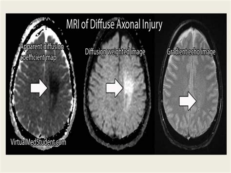 Presentation Radiological Application Of Diffusion Weighted Imges In Neuroradiology PPTX
