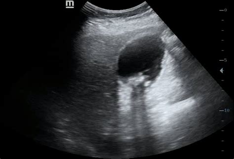 Sonographic Murphys Sign Global Ultrasound Institute