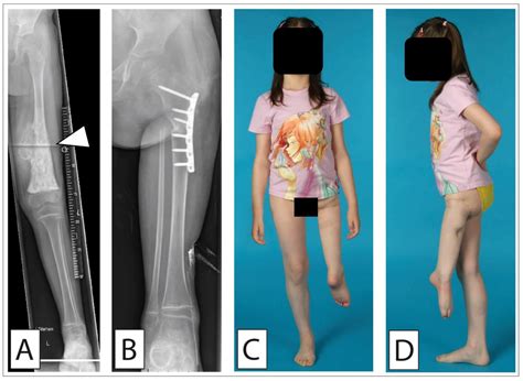 Osteosarcoma Knee Tumor