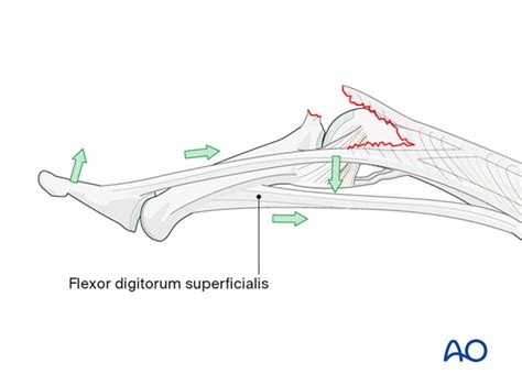 Dislocation Of The Proximal Interphalangeal Joint Dislocation Of The Proximal Interphalangeal Joint