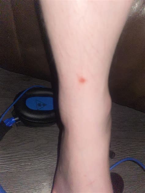 Red Bump On Leg Wont Go Away R Skincareaddicts