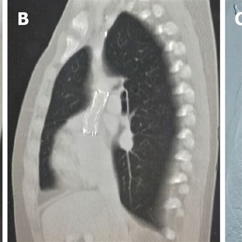 A 25 Yr Old Female Postoperative Review Of Sharp Recanalization Download Scientific Diagram