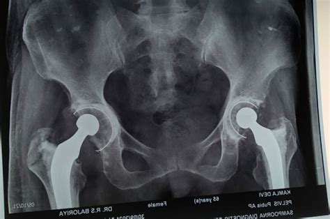 Acetabular Pelvic Surgery Dr R S Bajoria