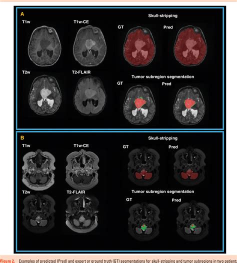 Figure 2 From Automated Tumor Segmentation And Brain Tissue Extraction From Multiparametric Mri