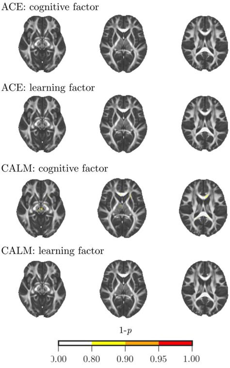 Results Of Voxel Wise Analysis Using Tract Based Spatial Statistics