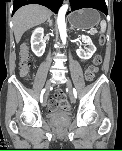 Gastric Gist Tumor Stomach Case Studies Ctisus Ct Scanning