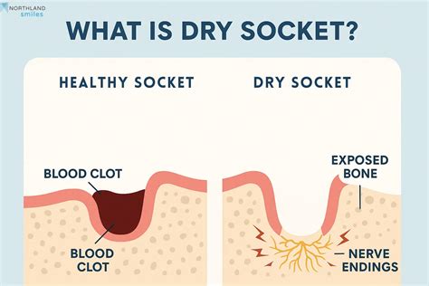 Dry Socket Symptoms Causes And Effective Treatments Northland Smiles Dental
