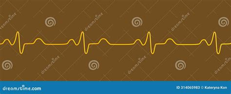 Ecg Of Bundle Branch Block 3d Illustration Royalty Free Cartoon