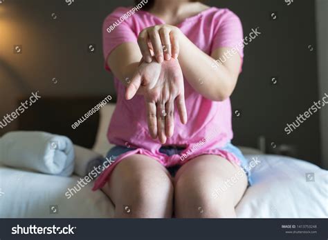 Hand Woman Rash Papule Scratch On Stock Photo Shutterstock