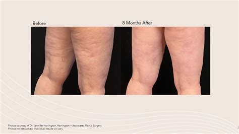 A Closer Look At Cellulite Treatment Evaluating The Pros And Cons