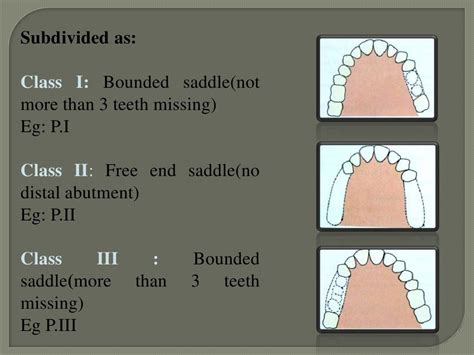 Classification Of Rpd