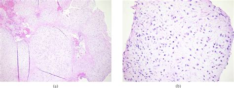 A Representative Section Of Endotracheal Tumour Showing A Chondroid Download Scientific