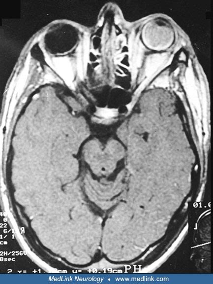 Sturge Weber Mri