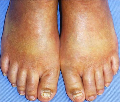 Drug Induced Localised Scleroderma The Bmj