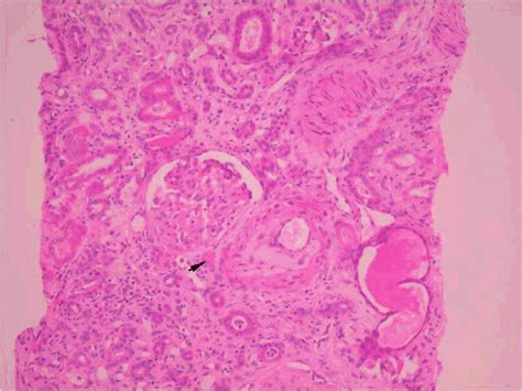 Interlobular Artery Showing Prominent Intimal Myxoid Thickening With Download Scientific