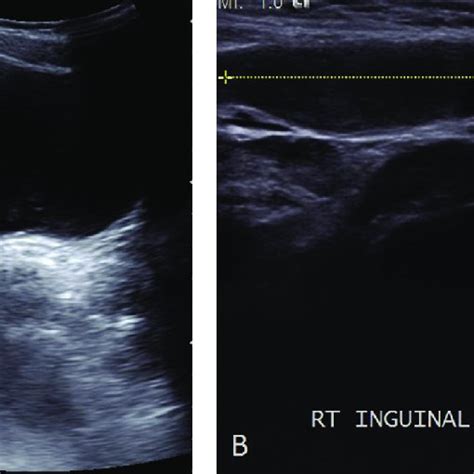 PDF Imaging Evaluation Of Disorders Of Sex Development