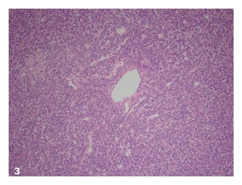Hypercellular Spindle Cell Neoplasm With Hemangiopericytoma Like Download Scientific Diagram