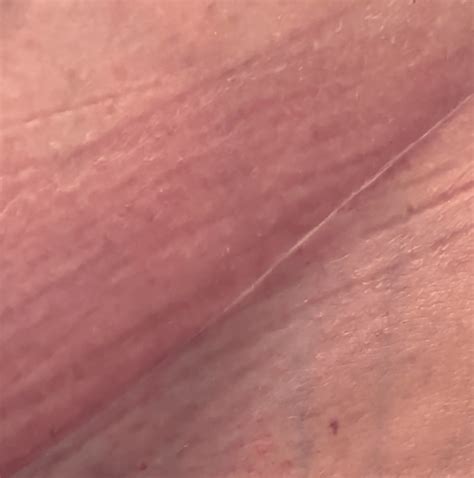 Evolution Of Tummy Tuck Techniques Neinstein Plastic Surgery