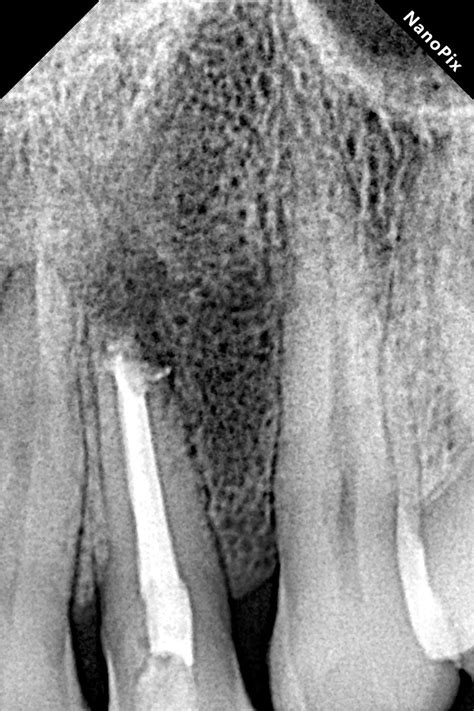 Apicoectomy Surgery Of Upper Lateral Incisor 6 Months Post Up Healing And Bone Regeneration