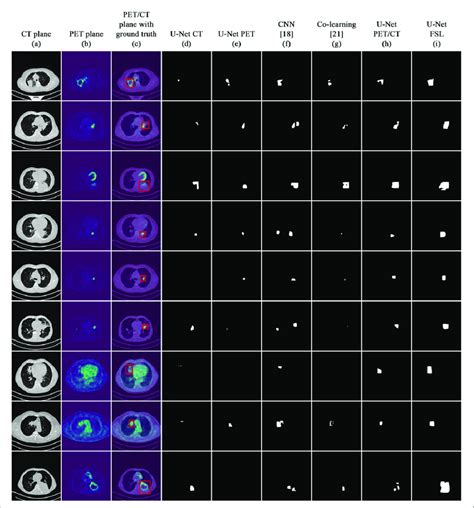Visual Comparison Of The U Net Model Outputs For Different Lung Cancer
