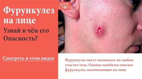Фурункул на лице в чём его ОПАСНОСТЬ Смотрите в этом видео Youtube