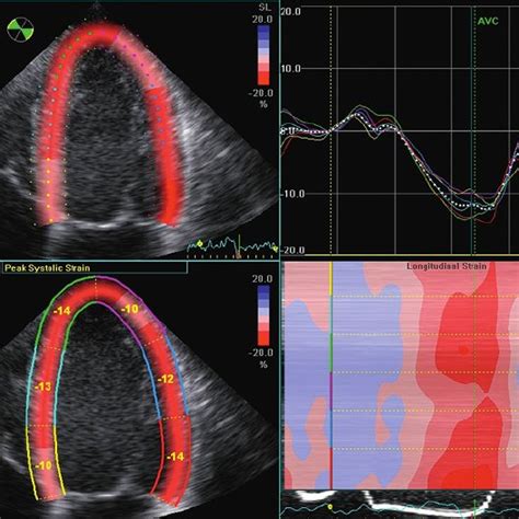Apical Four Chamber Two Dimensional Speckle Tracking Derived