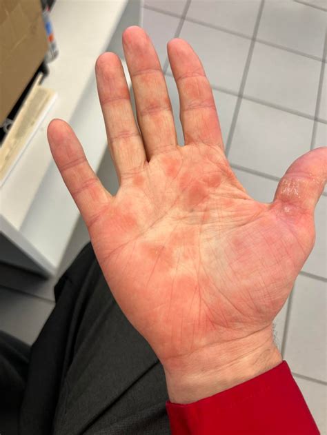 My Hospital Stay R Scleroderma