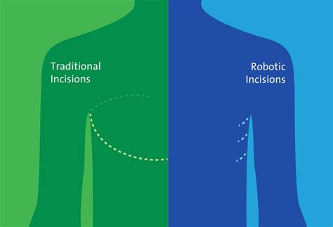 Thoracic Surgery At Lenox Hill Hospital Heart And Lung Manhattan Ny