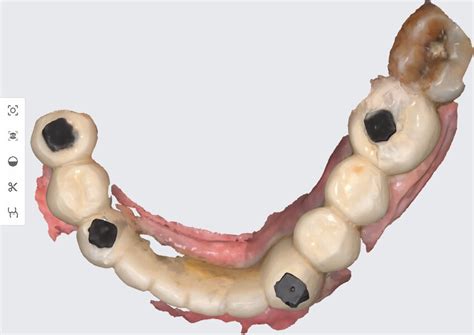Intra Oral Scanning Of Long Span Fixed Prosthesis With Reference