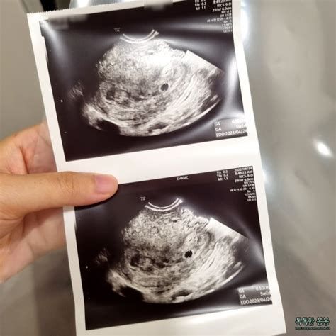 임신 4주차 극초기 증상 및 초음파 아기집 크기 확인 네이버 블로그
