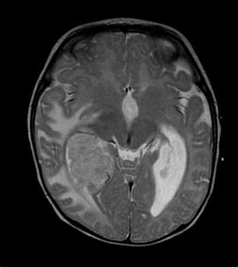 Choroid Plexus Carcinoma Tumor Mapasgmaes