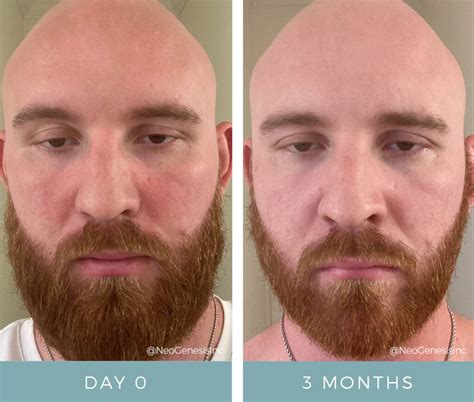 Managing Seborrheic Dermatitis With Neogenesis Products