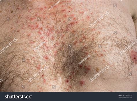 Chest Skin Rash Drug Side Effect Stock Photo Shutterstock