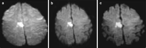 30 T Imaging Of Ischemic Stroke Radiology Key