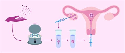 Process of IVF with donor sperm
