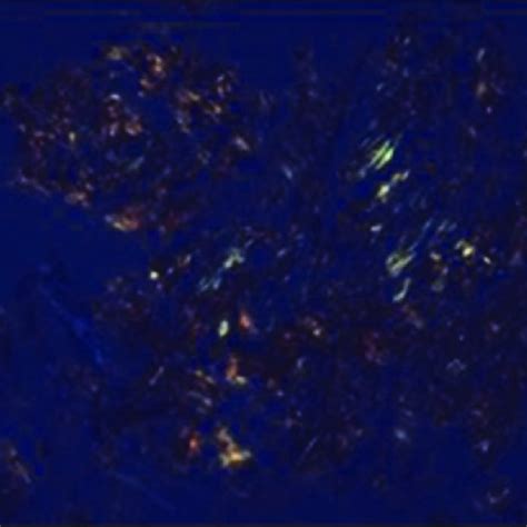 Sclerotic Tissue From Mediastinal Mass Was Positive For Congo Red With Download Scientific