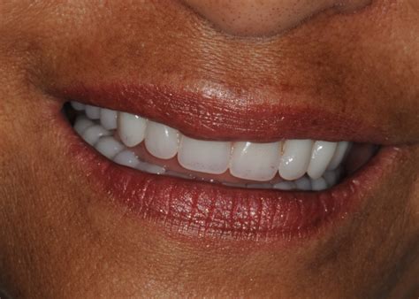 An Affordable Treatment For Complete Replacement Of Missing Teeth With Implant Supported