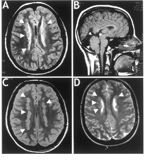 Periventricular Nodular Heterotopia Semantic Scholar