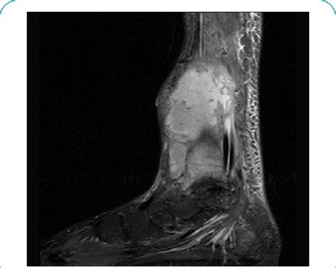 A Mri Of Left Tibia Extensive Soft Tissue Swelling Download Scientific Diagram