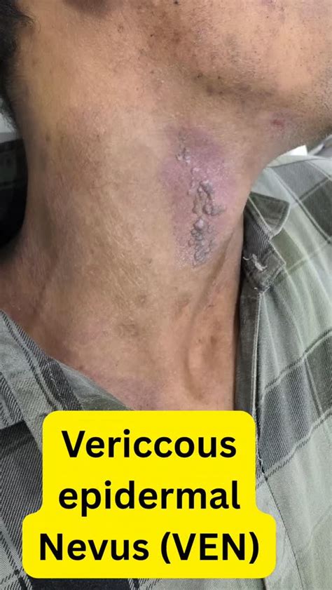 Linear Epidermal Nevus Causes