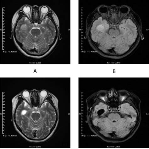 Autoimmune Epilepsy Diagnostic Criteria Stratified As Per Antibody